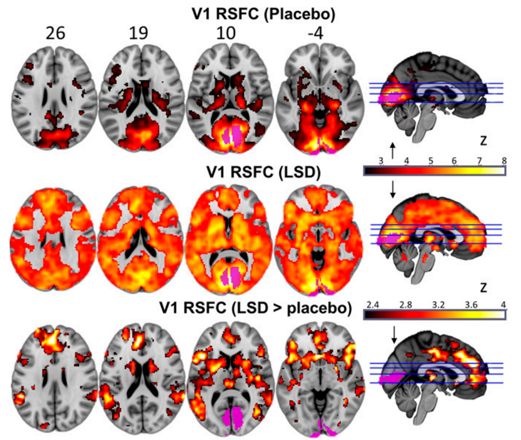 Primer estudio que observa el cerebro bajo los efectos del LSD ofrece pistas acerca de la ...